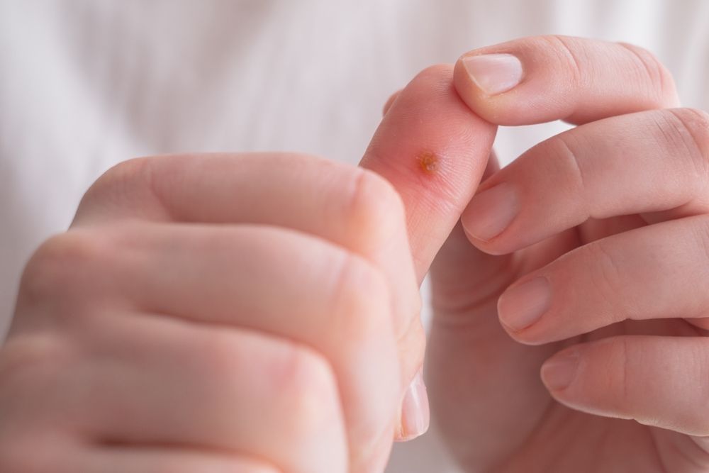 Infecção por HPV: diagnóstico, tratamento e prevenção! | Fleury ...